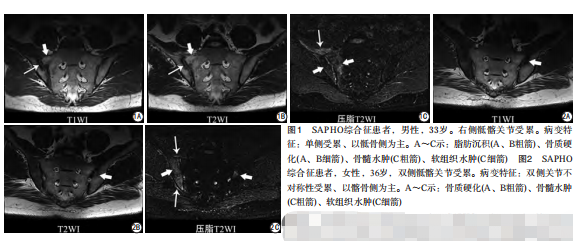SAPHO综合征患者骶髂关节病变MRI表现的研究结果 - 知乎
