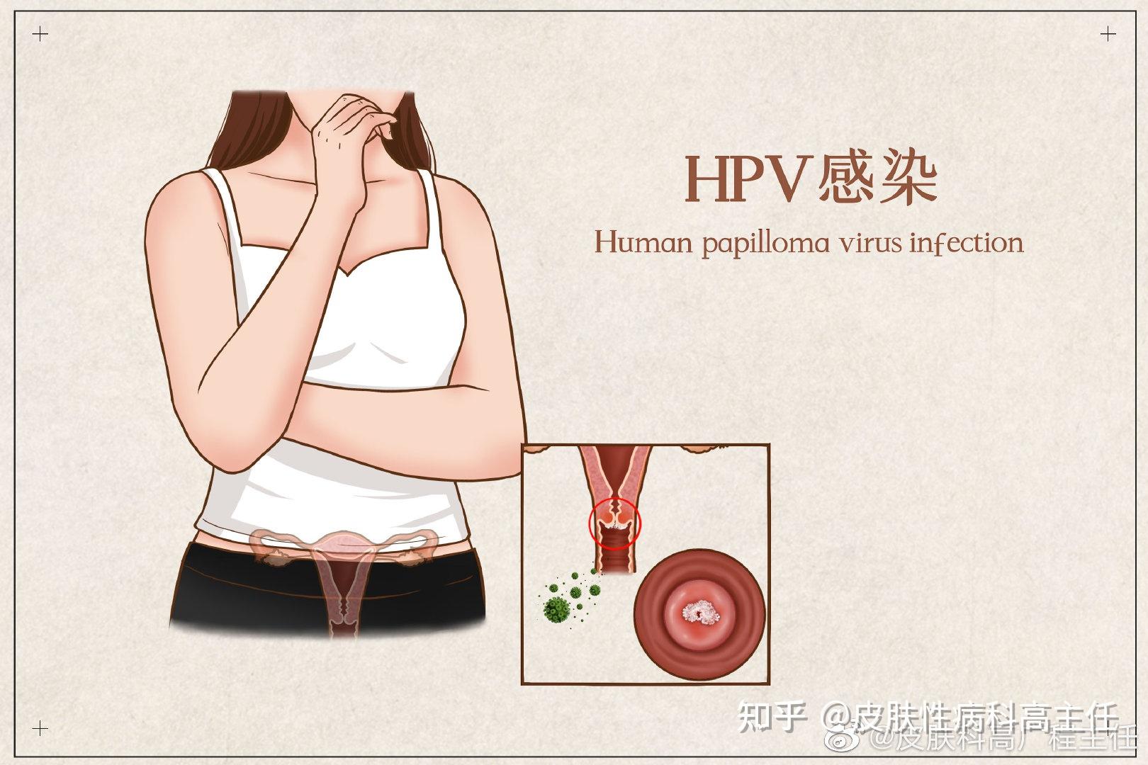 男性hpv感染转阴以后可以正常家庭生活吗？ - 知乎