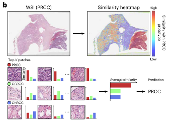 Nature Medicine｜Towards a general-purpose foundation model for computational pathology 论文分享 - 知乎