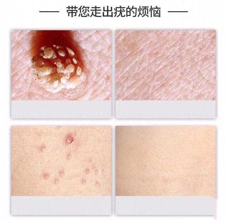 关于尖锐湿疣的大实话 知乎