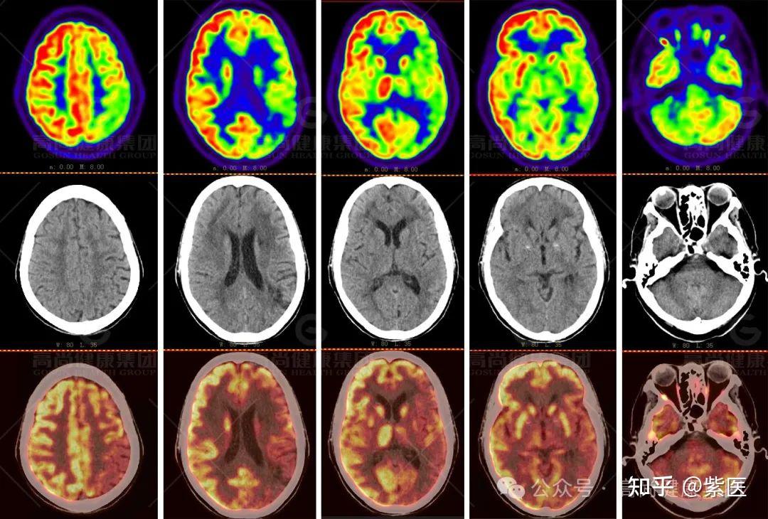 学术荟萃系列专题 | PET脑成像在阿尔茨海默病的应用价值 - 知乎