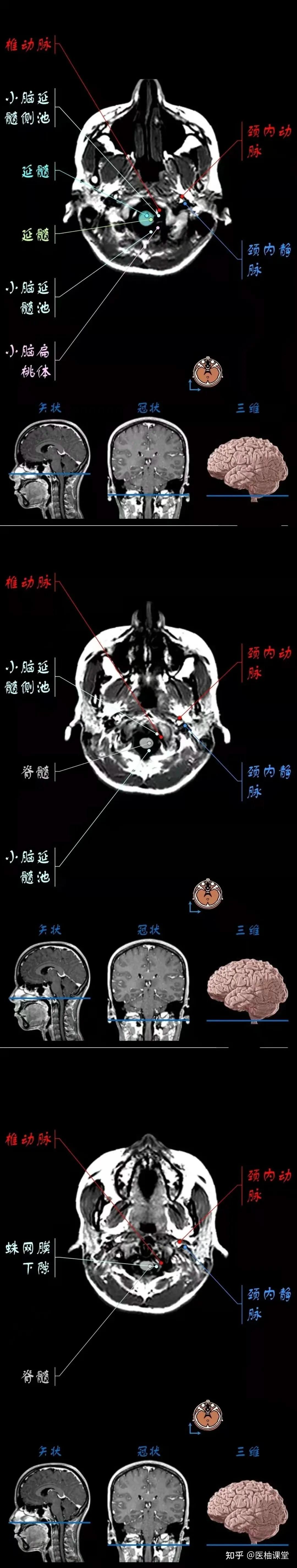 颅脑MRI详细三维标注图（收藏） - 知乎