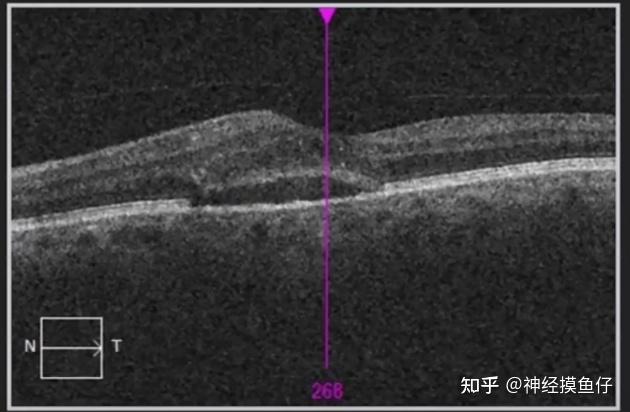 OCT阅片（持续更新 - 知乎