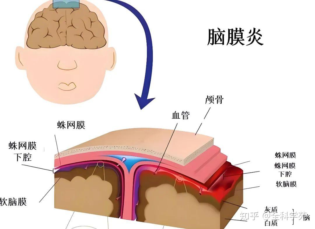 什么是结核性脑膜炎？症状、诊断及治疗策略 - 知乎