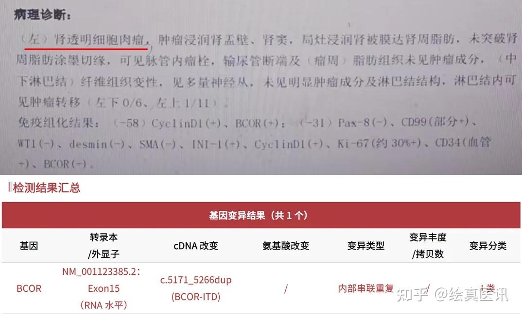 “绘”真报告丨RNA水平检出BCOR-ITD变异，辅助肾透明细胞肉瘤精准诊断 - 知乎