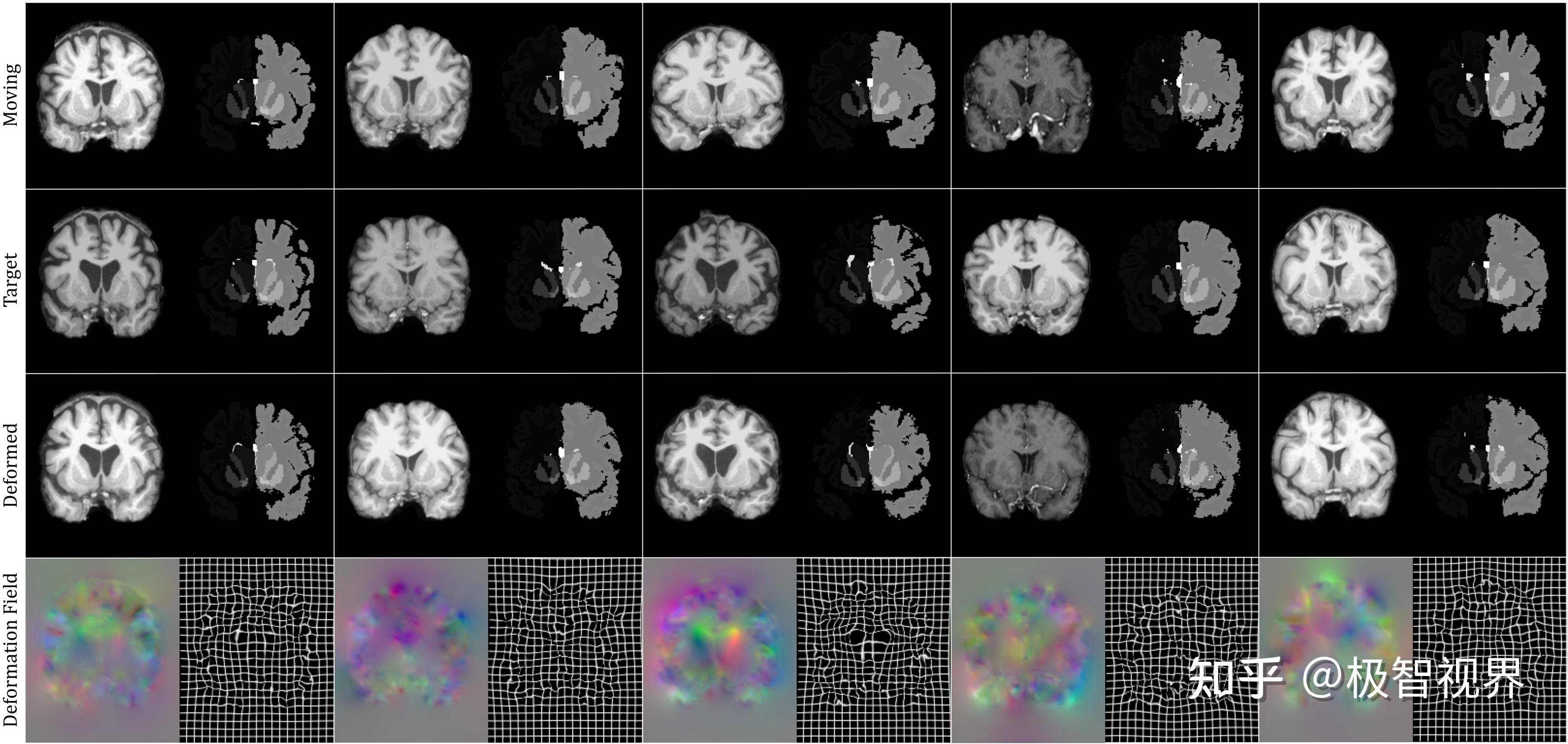 3D医疗图像配准 | 基于Vision-Transformer+Pytorch实现的3D医疗图像配准算法 - 知乎