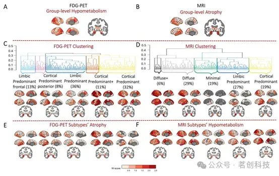 Brain Commun | 不同的神经退行性模式：FDG-PET与基于MRI的阿尔茨海默病亚型比较 - 知乎