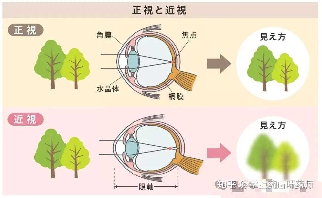 日本首款近视控制滴眼液0.025%硫酸阿托品（RYJUSEA® Mini ）获批上市，守护视力新选择 - 知乎