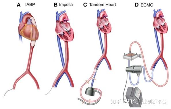 人工心脏4——一文浅析短期PVAD（上） - 知乎