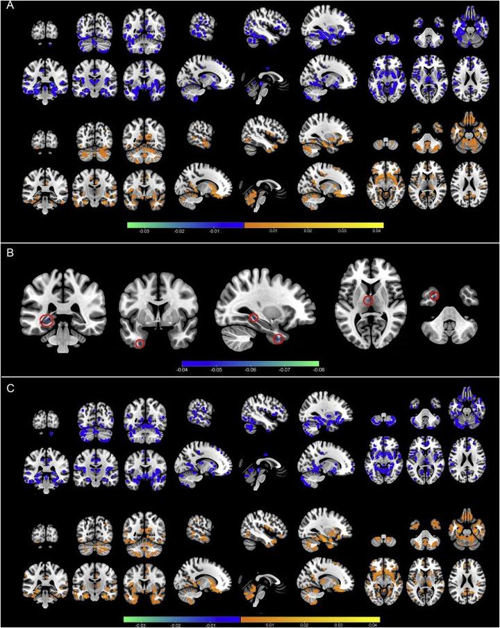 静息态EEG和结构MRI对AD与MCI分类的比较 - 知乎
