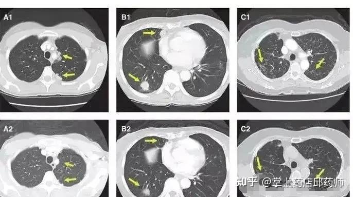 一文详解多靶点靶向药“万金油”卡博替尼(XL184)，国内已申报上市！ - 知乎