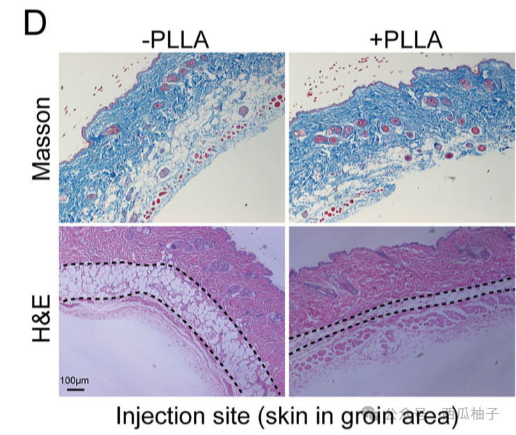 聚左旋乳酸（PLLA）的抗衰机制！ - 知乎