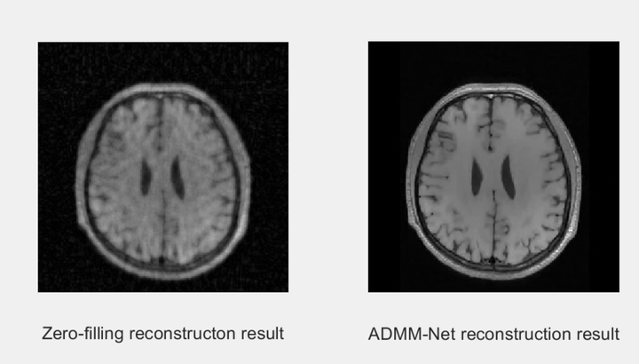 【ADMM】基于交替方向乘法器(ADMM)算法优化基于cs的速磁共振成像MRI研究（Matlab代码实现） - 知乎