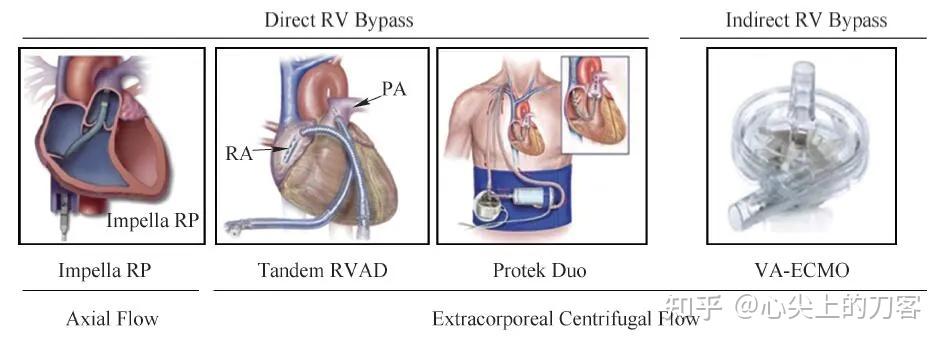 终末期心力衰竭机械循环支持的治疗进展 - 知乎