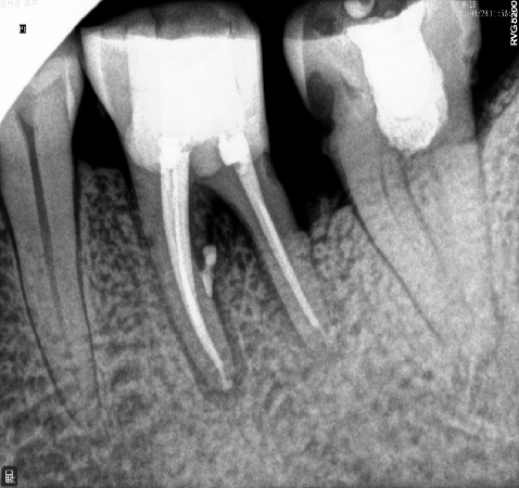 36根管治疗一例 | 黄伟琦医生使用赛濡特C-Root SP充填案例 - 知乎