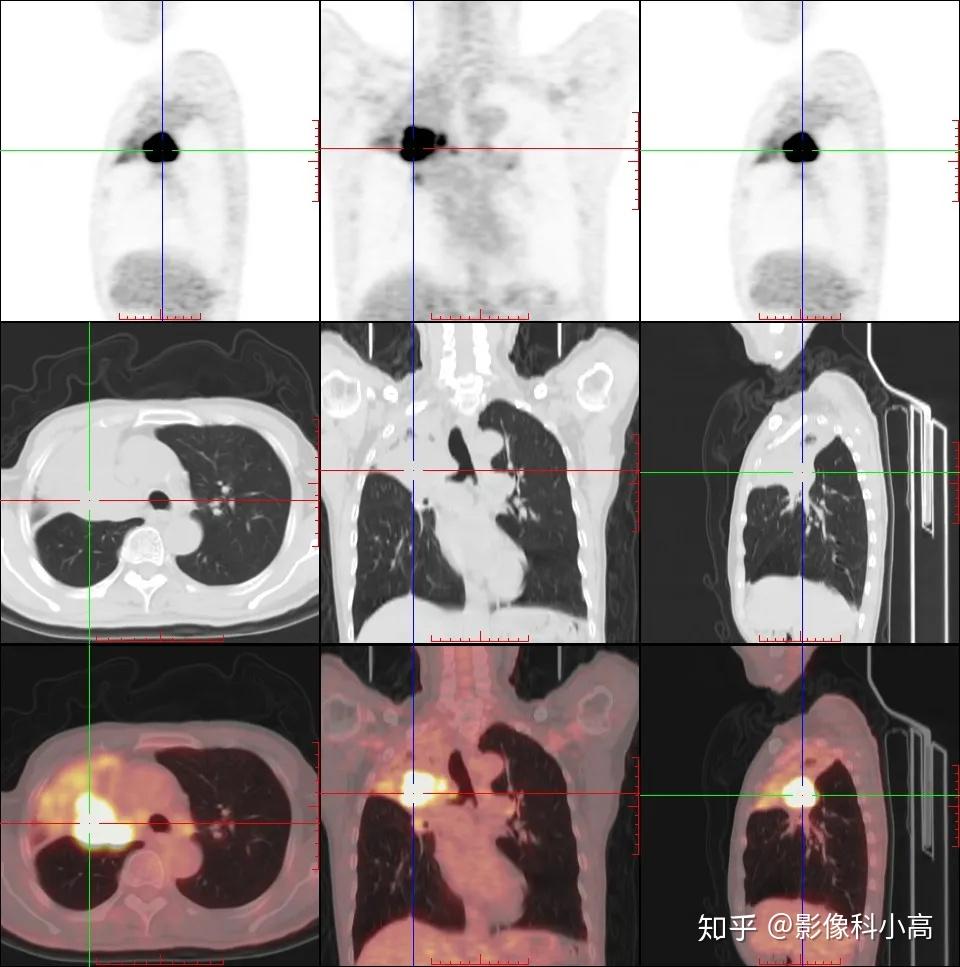 肿瘤精准诊疗之利器——PET/CT - 知乎
