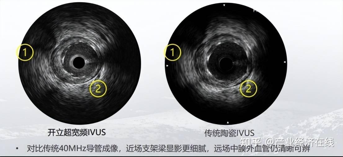 打开IVUS新局面，开立医疗再迈重要一步 - 知乎