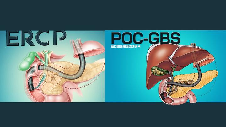 经口胆囊超级微创保胆取石手术和Ercp技术有哪些区别？ - 知乎