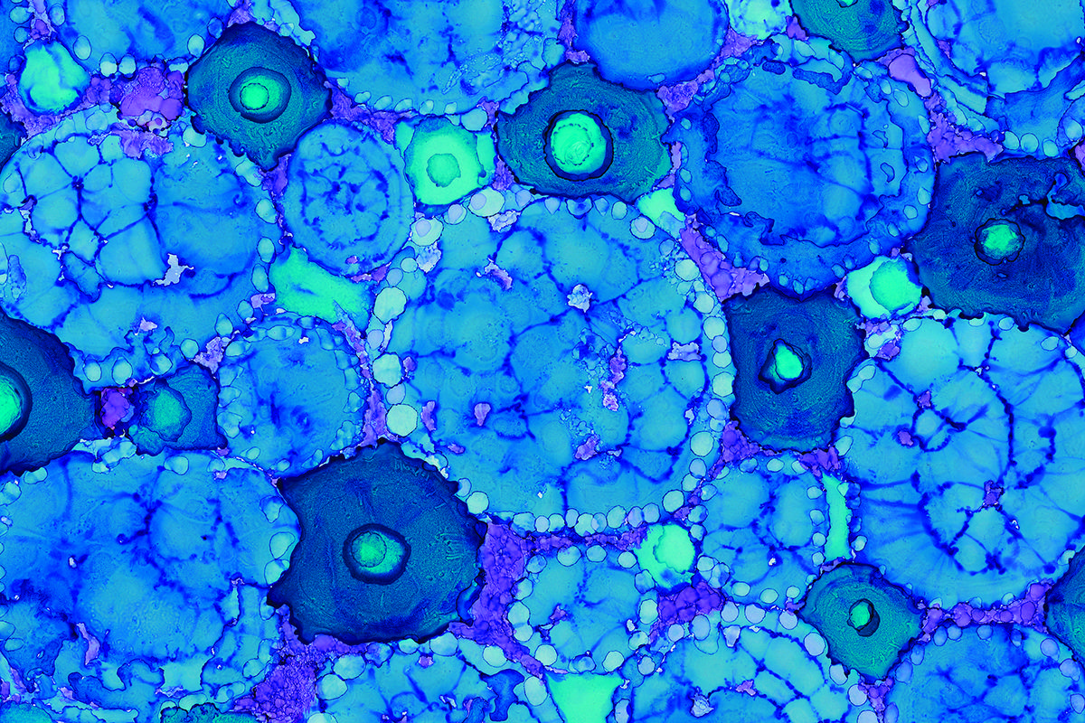 重磅！Vertex表明全球首款针对1型糖尿病的细胞疗法进入3期临床试验！ - 知乎