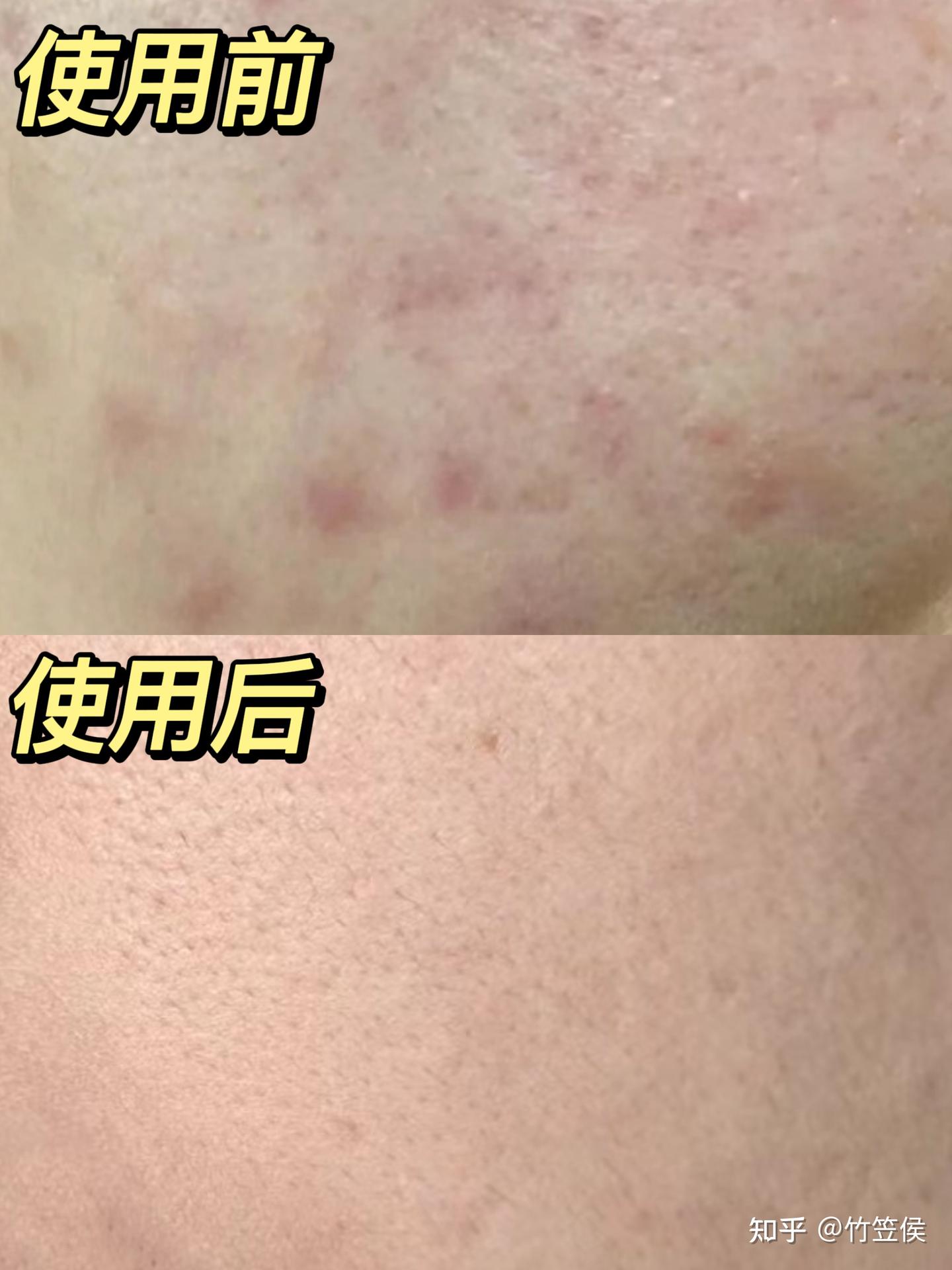 测肤仪和家用测肤镜 我最后选择了喜境simetra - 知乎