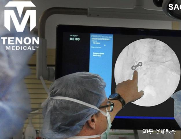 【美股打新第87期】加利福尼亚医疗器械Tenon Medical Inc(TNON) - 知乎