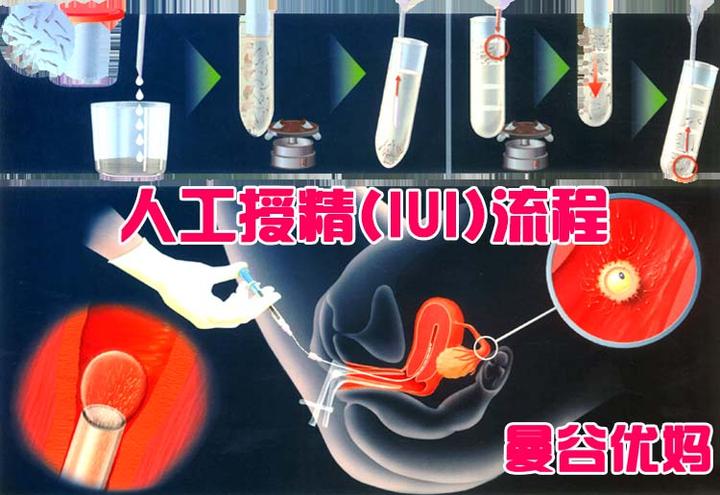 曼谷优妈-IUI是什么意思？试管婴儿知识科普 - 知乎