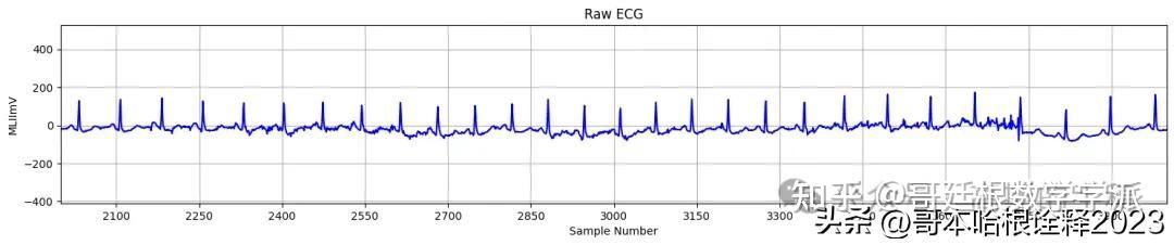 心电信号ECG处理分析（滤波降噪，QRS波检测等，Python） - 知乎