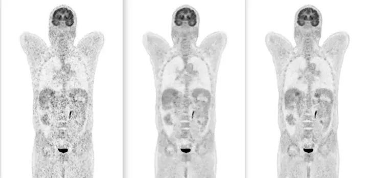 临床案例——RaDynMR、RaDynPET、RaDynCT、RaDynSPECT - 知乎