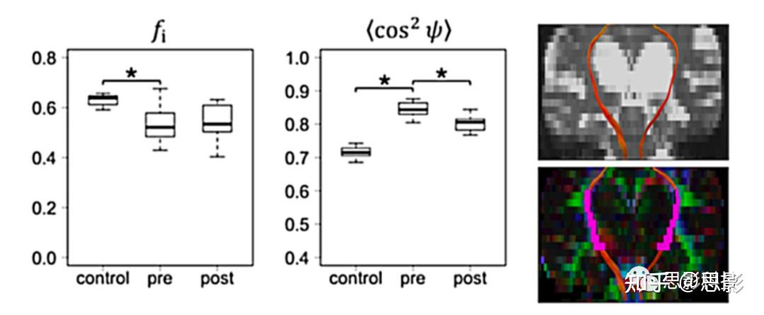 NODDI在临床研究中的应用 - 知乎