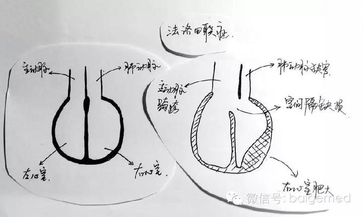 法洛氏四联症（Tetralogy of Fallot） - 知乎